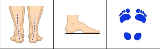 Foot Assessment - Custom Made Orthotics